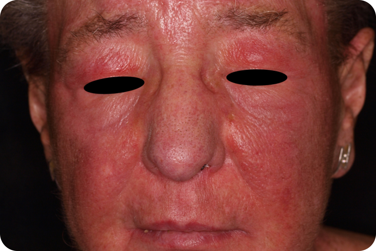 6. Dermatomiositis | NovartisPro España