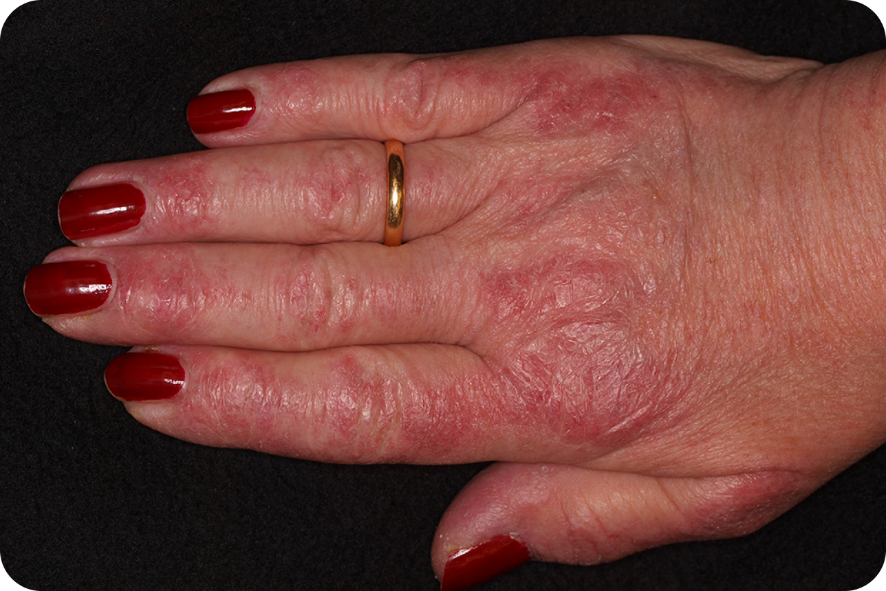 6. Dermatomiositis | NovartisPro España